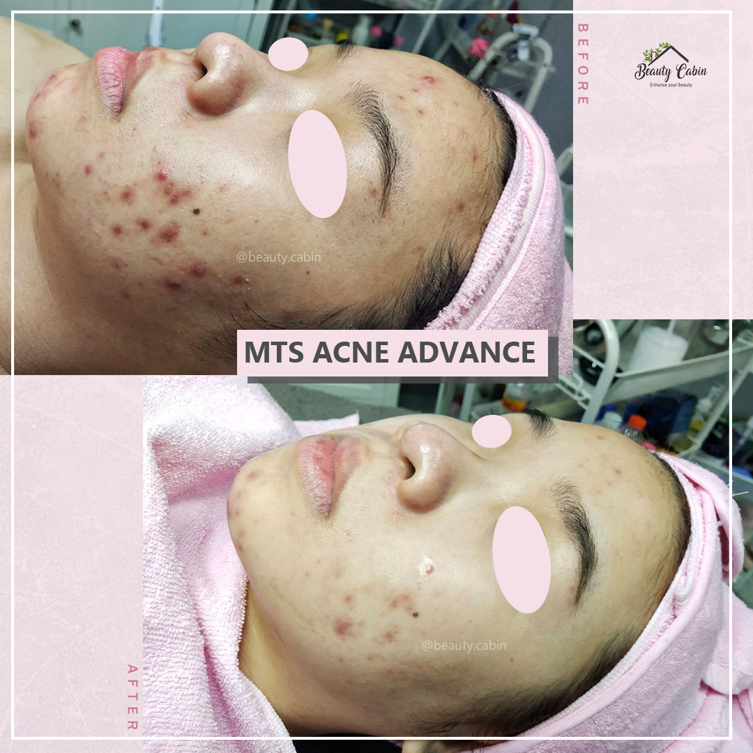 Treatment Mts Di Jakarta Barat | Hello-Beauty Cabin