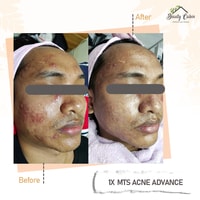 Treatment Mts Di Jakarta Barat | Hello-Beauty Cabin