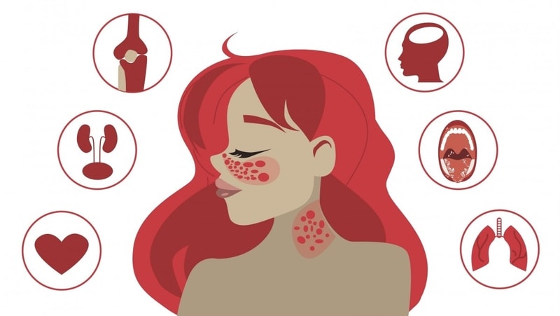 Hari Lupus Sedunia - Penyakit Autoimun Yang Diderita Isyana Sarasvati ...